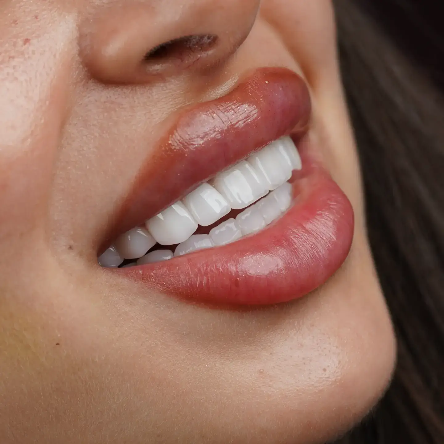 Dental Implant | LIN