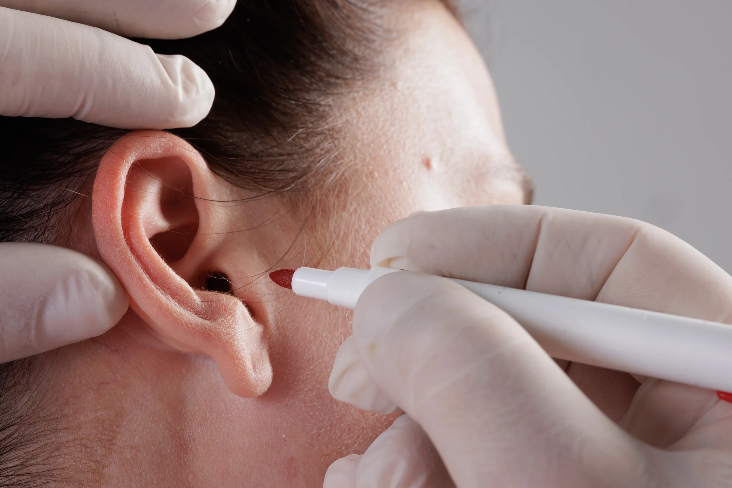 Otoplasty | LIN