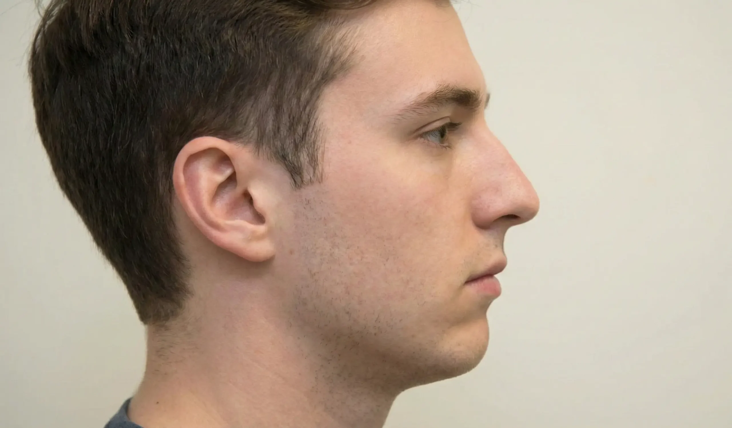Sliding Genioplasty or Chin Implants: Which is Better? | LIN